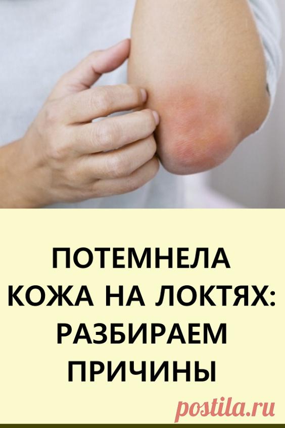 Потемнела кожа на локтях разбираем причины Приветствую Вас мои доро Здоровье Постила
